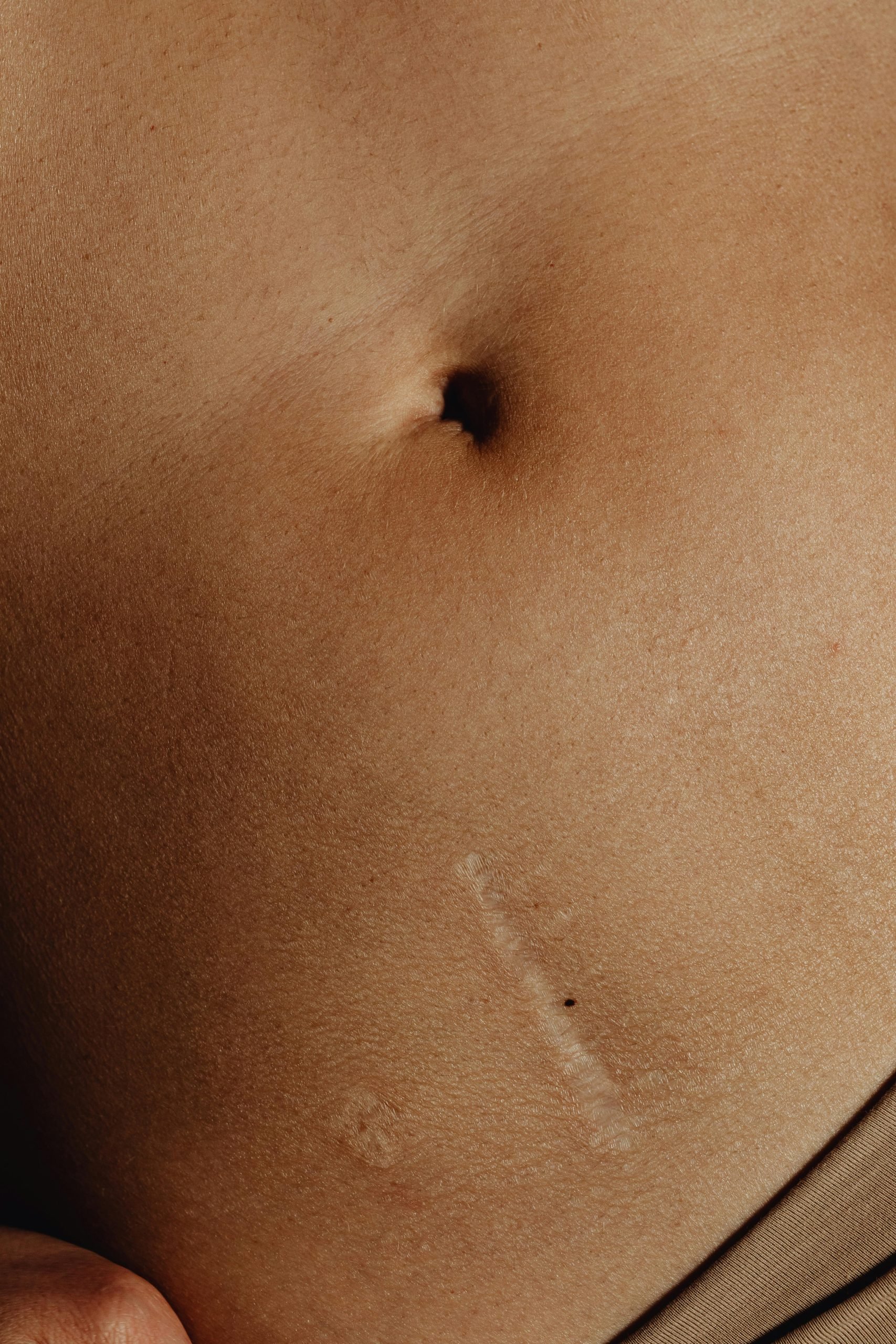 Cicatrice chéloïde : astuces pour en atténuer l'apparence - Sante Nutri